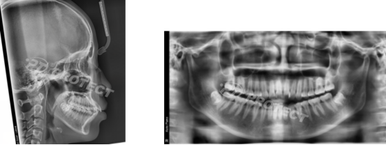 Analysis Of Upper Jaw Protrusion, Lower Jaw Retrusion. - PROTECT