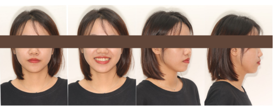 Analysis Of Upper Jaw Protrusion, Lower Jaw Retrusion. - PROTECT