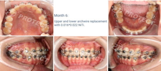 Analysis Of Upper Jaw Protrusion, Lower Jaw Retrusion. - PROTECT